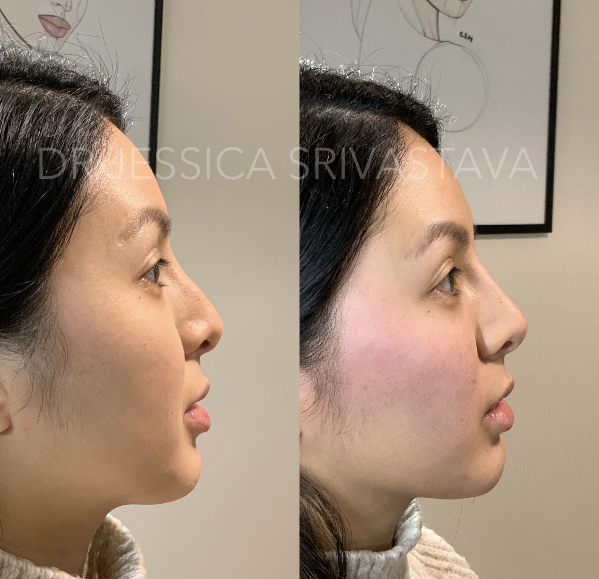 Bespoke full face filler | Dr. Jess Aesthetics
